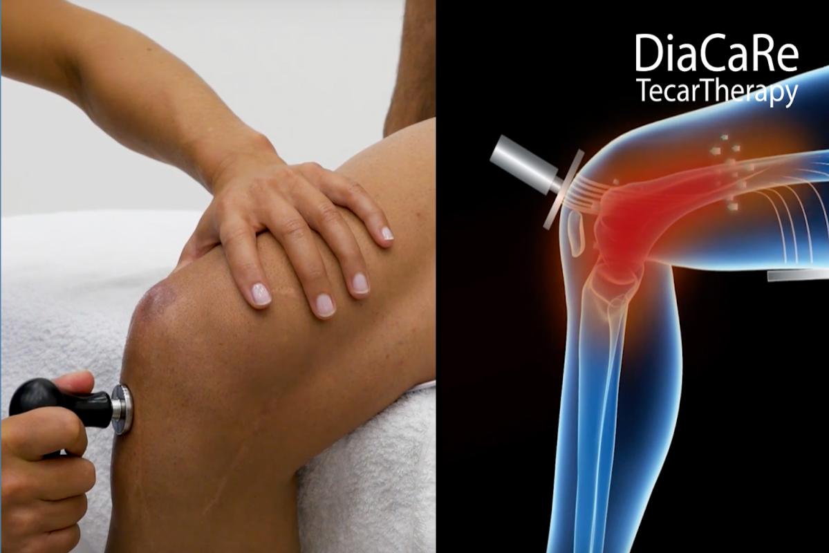 TECAR vs Shockwave: Comparing Two Popular Therapies for Recovery